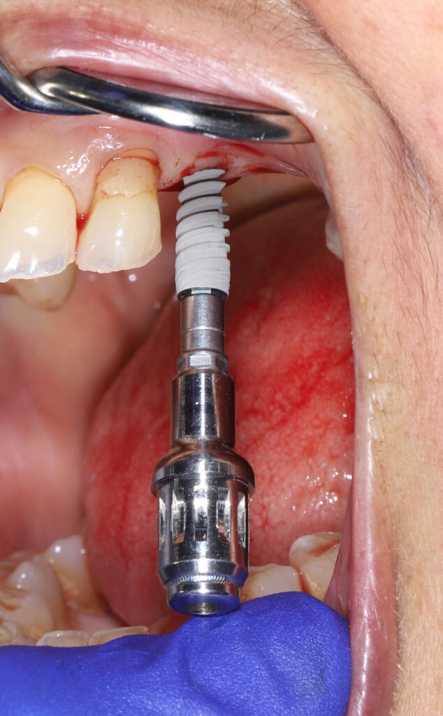 Implant dentistry & surgery - Hodcaa Dental Clinic | Laser Dentistry ...